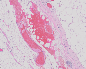 Chest Wall | College of American Pathologists