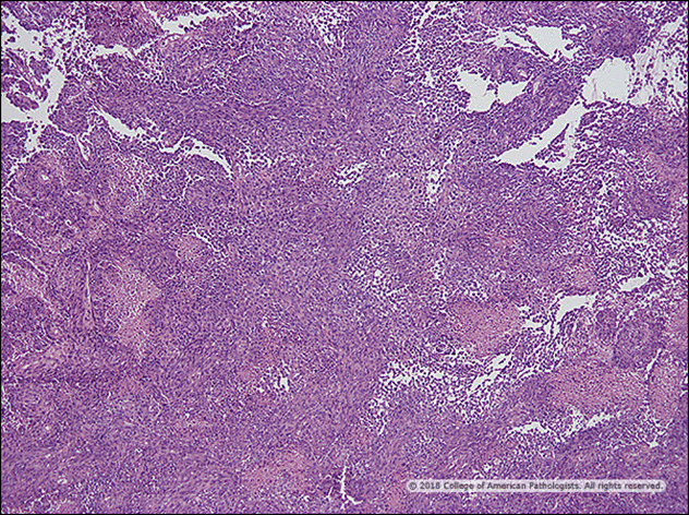 2018 NPB-11 | College of American Pathologists