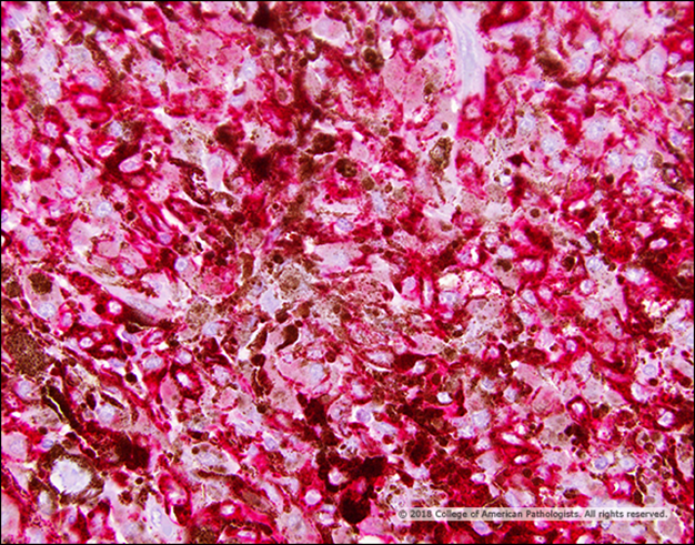 2018 NPB-14 | College of American Pathologists