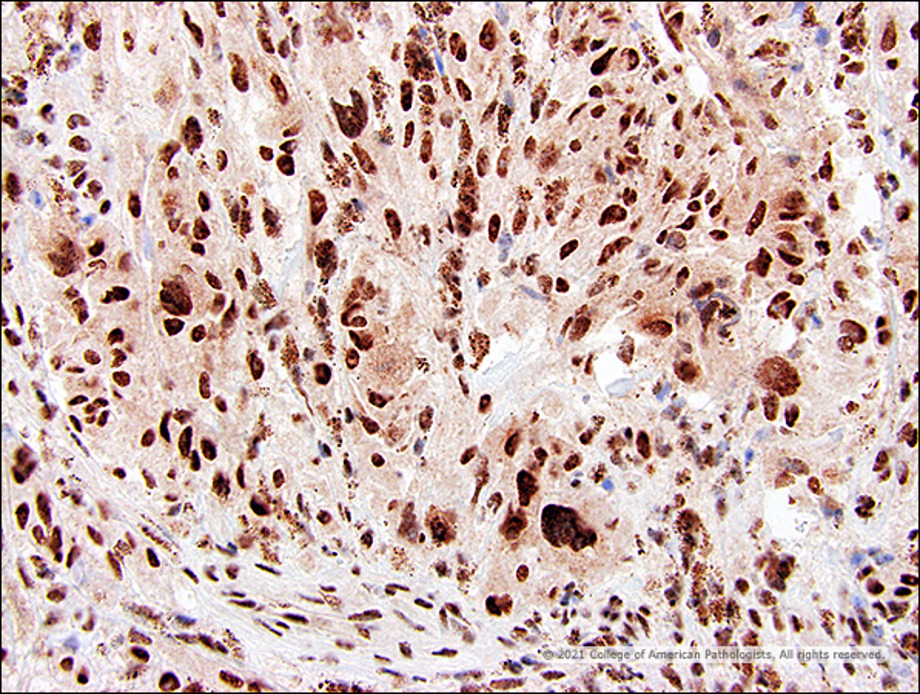 2021 NPA-04 | College of American Pathologists