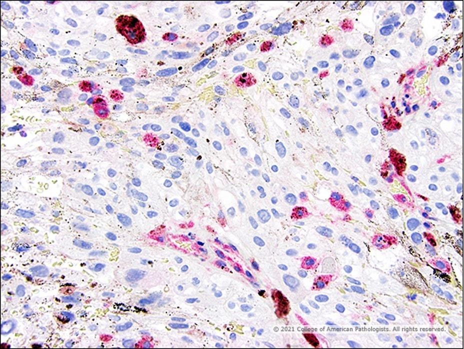 2021 NPA-04 | College of American Pathologists