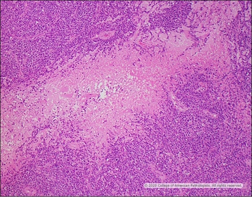 2020 NPB-11 | College of American Pathologists