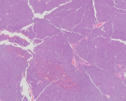 Retroperitoneal Lymph Node | College of American Pathologists