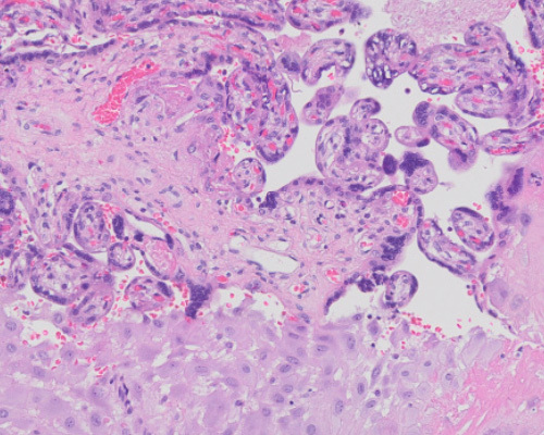 Placenta | College of American Pathologists