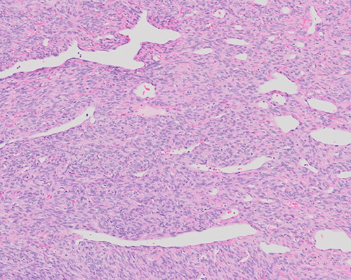 Inguinal Soft Tissue | College of American Pathologists